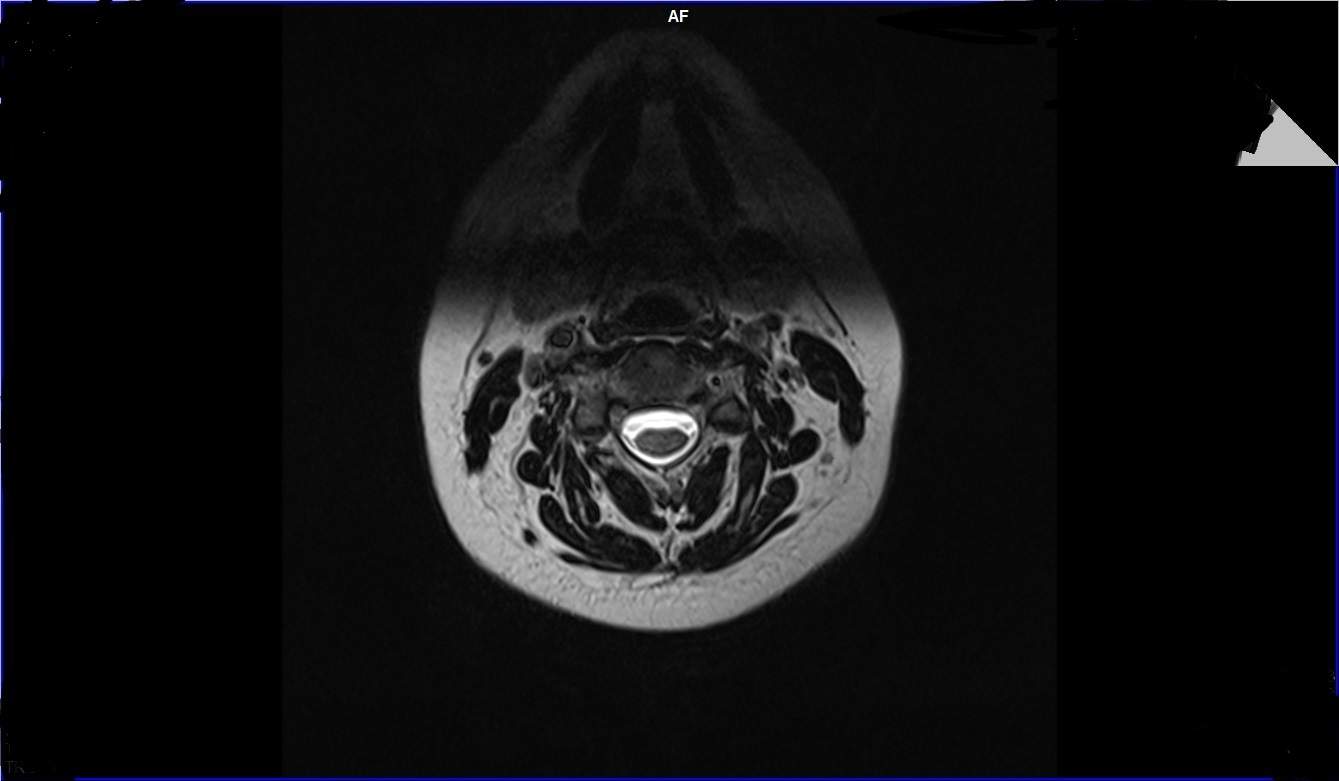 Hallo ihr lieben, was bedeutet es wenn bei einen MRT Bild bestimmte ...