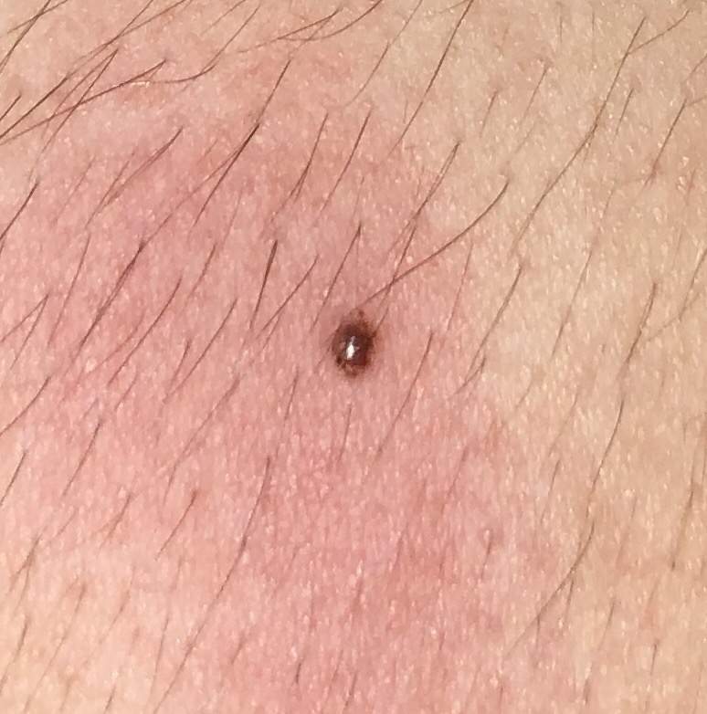 Ist das ein Muttermal? (Gesundheit, Hautkrebs)