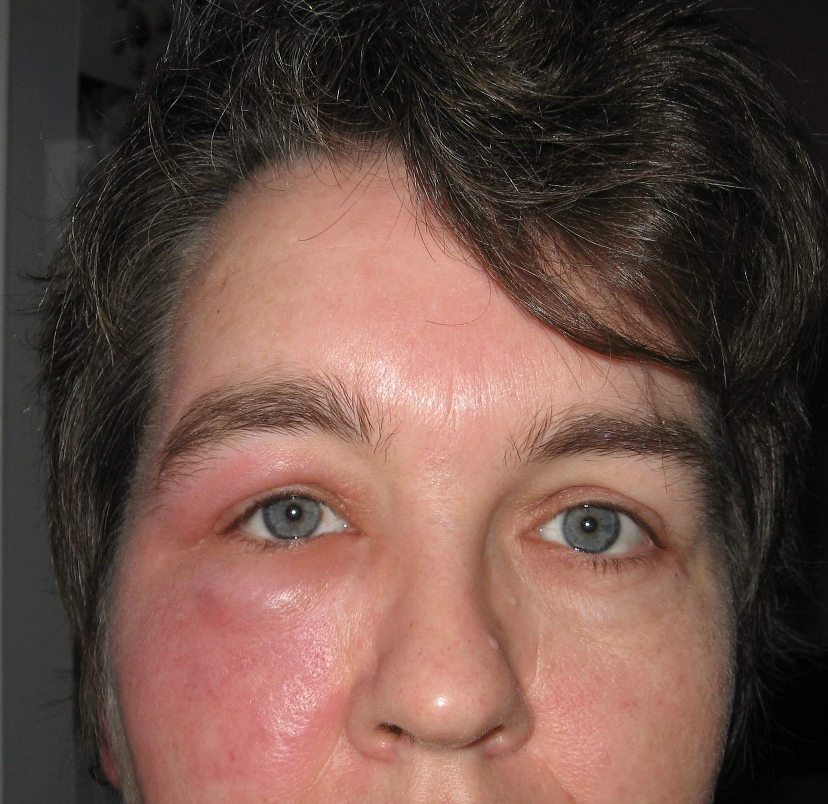 Gesichtsrose (Erysipel) seit letztes Jahr November (Haut, Ausschlag ...