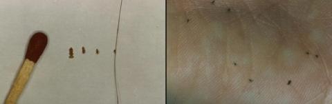 Nisse oder Kopfläuse- wie erkennt man den Unterschied? (Haut, Risse)