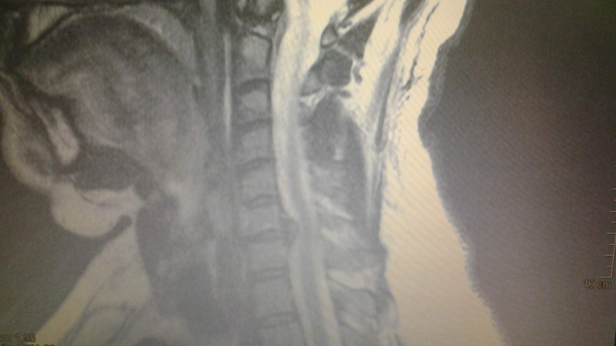 Bandscheibenvorfall c6 c7? (HWS)