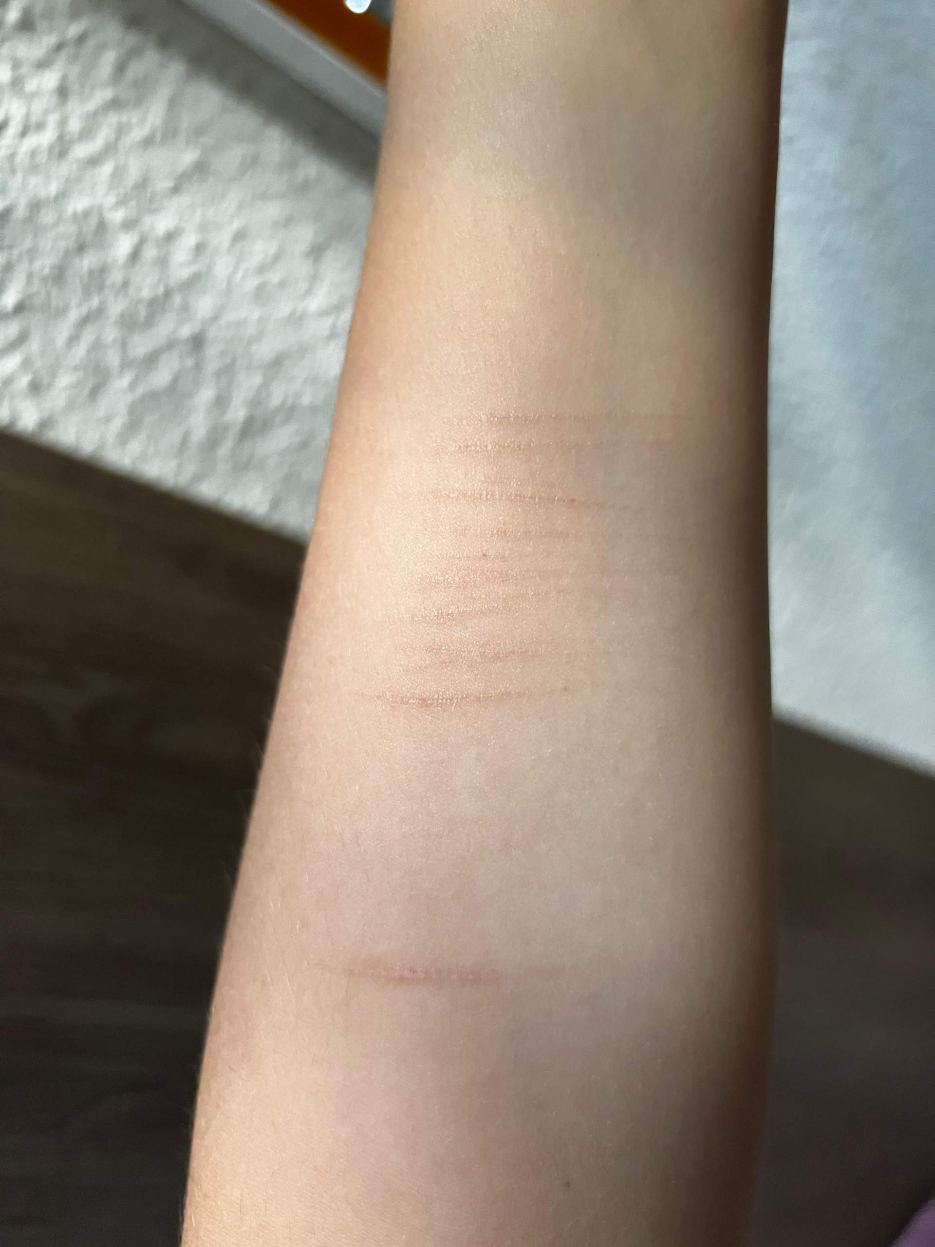 Das werden keine Narben, oder? (Haut, ritzen)