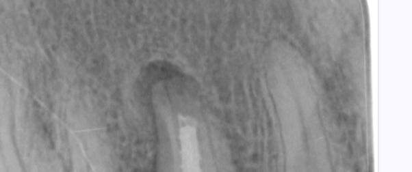 Erklären zu Zahn Bild? (Zähne, Behandlung, Zahnarzt)