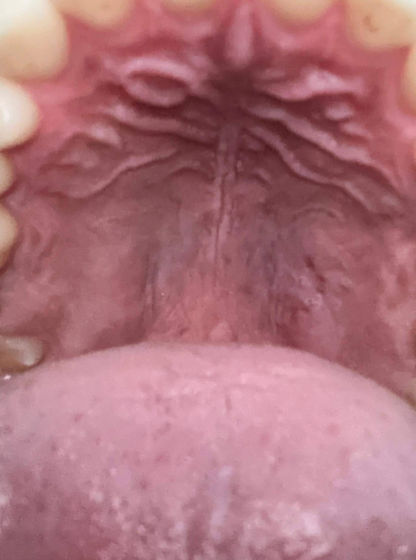 Gaumen geschwollen und rote Punkte, was könnte das sein? (Schmerzen ...