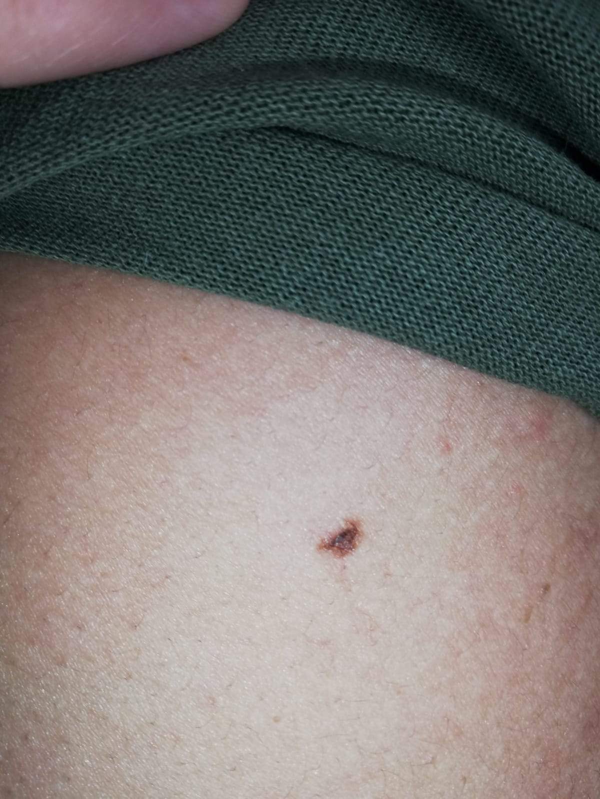 Gefährliches Muttermal? (Hautkrebs)