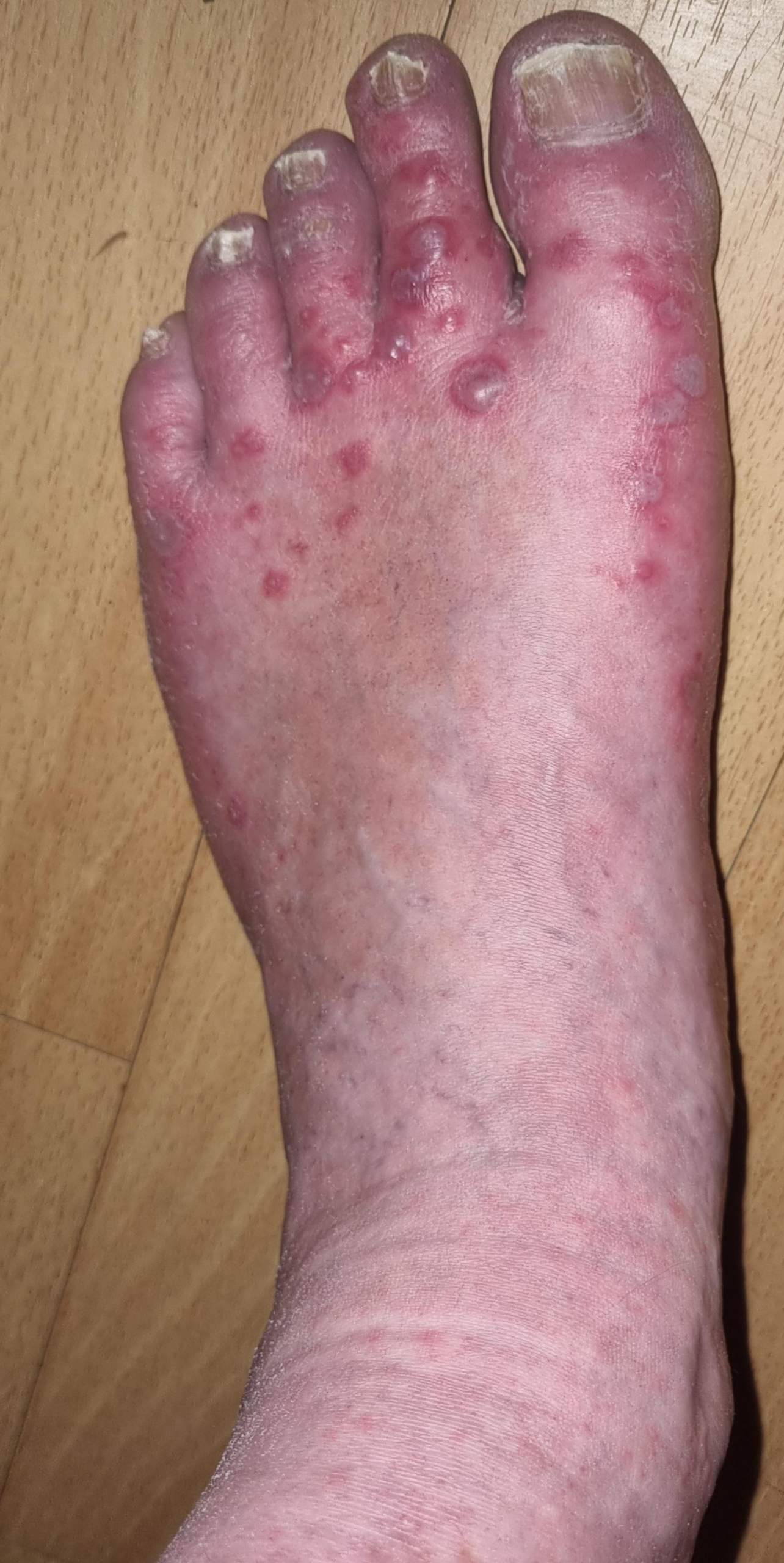 Hand Fuß Mund? (Füße)