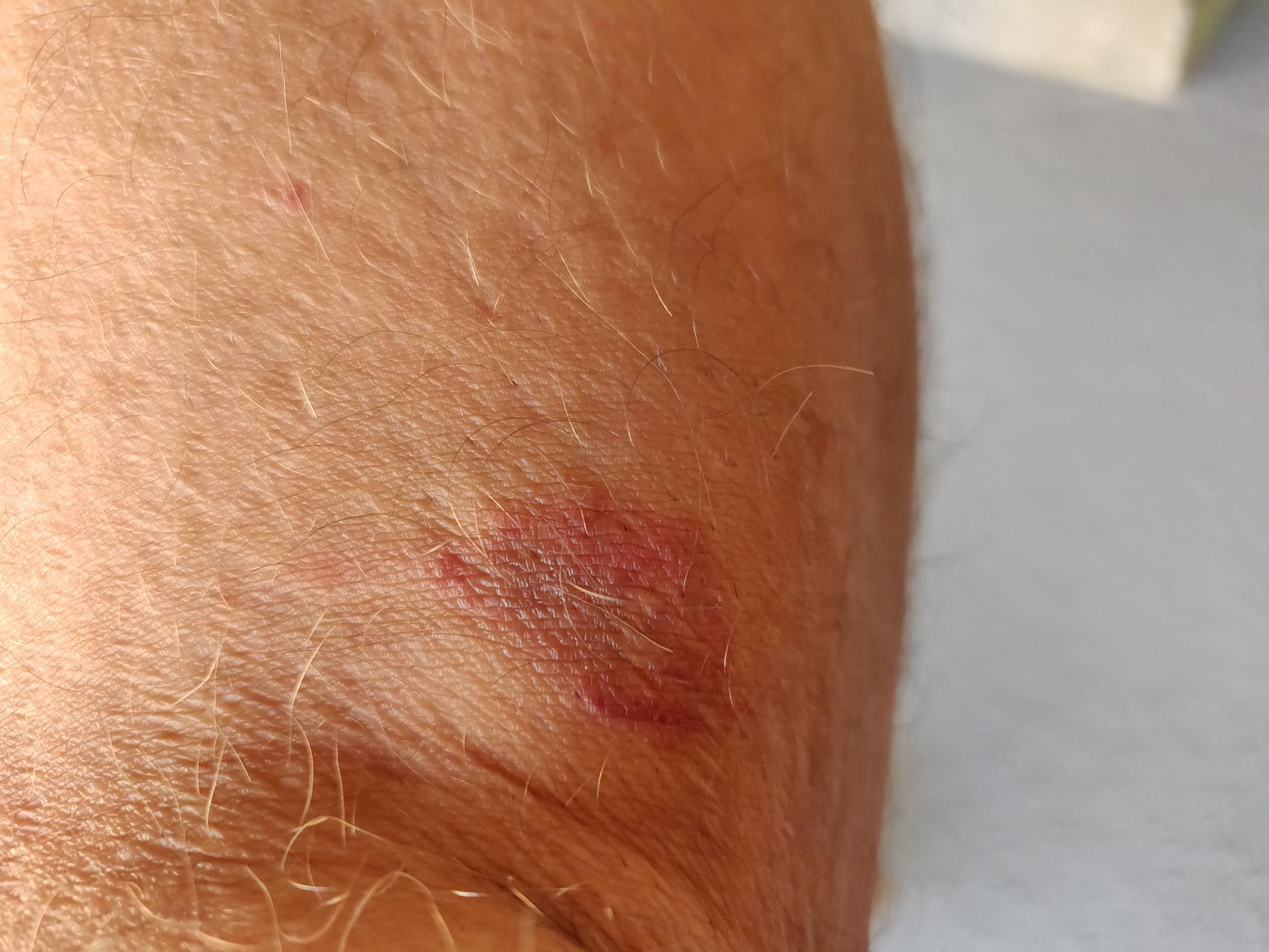 Rote Flecken Am Bein Bilder : Dermatitis – BKZXTZ