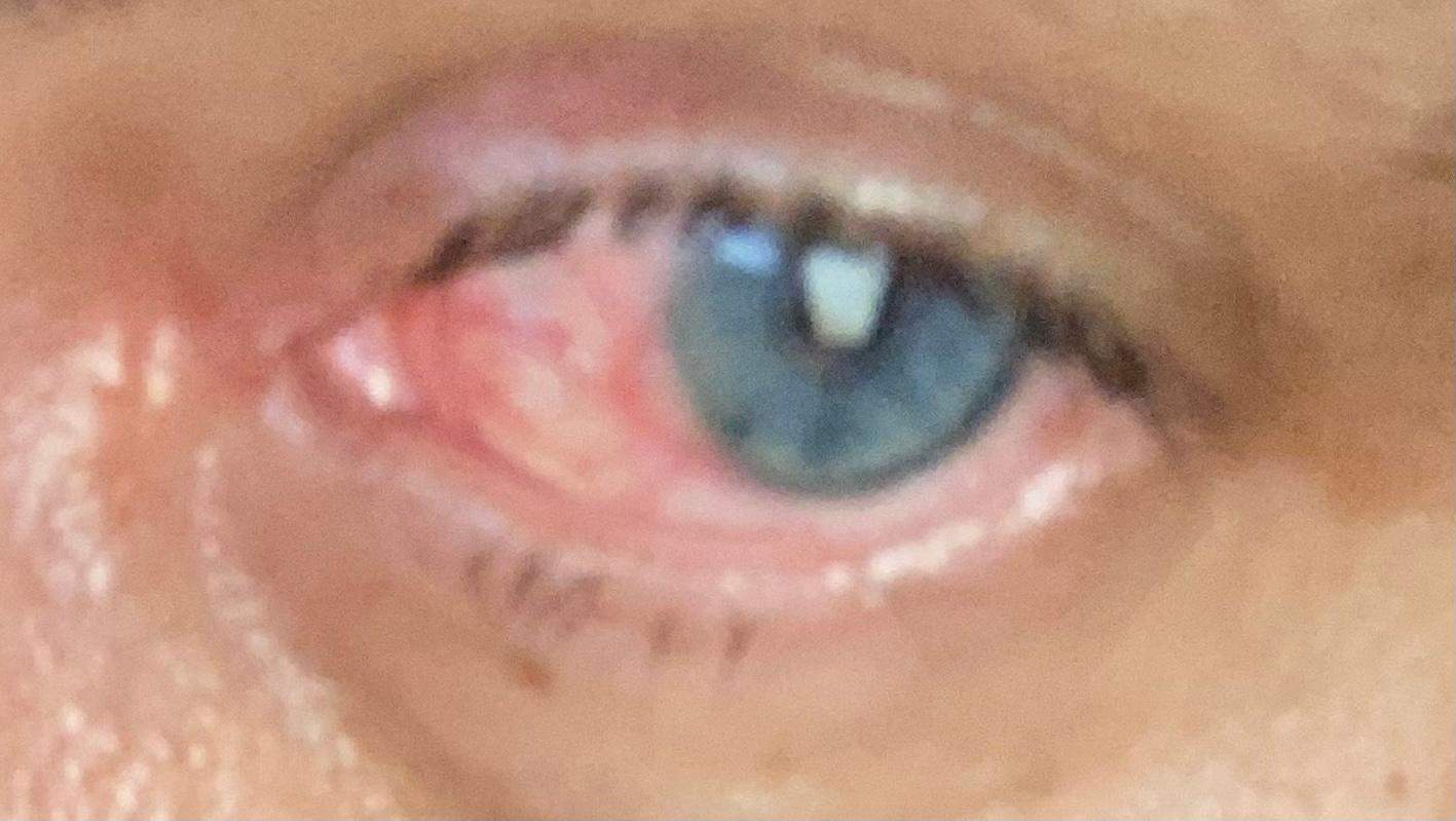 Herpes Zoster am Auge? (Augen)