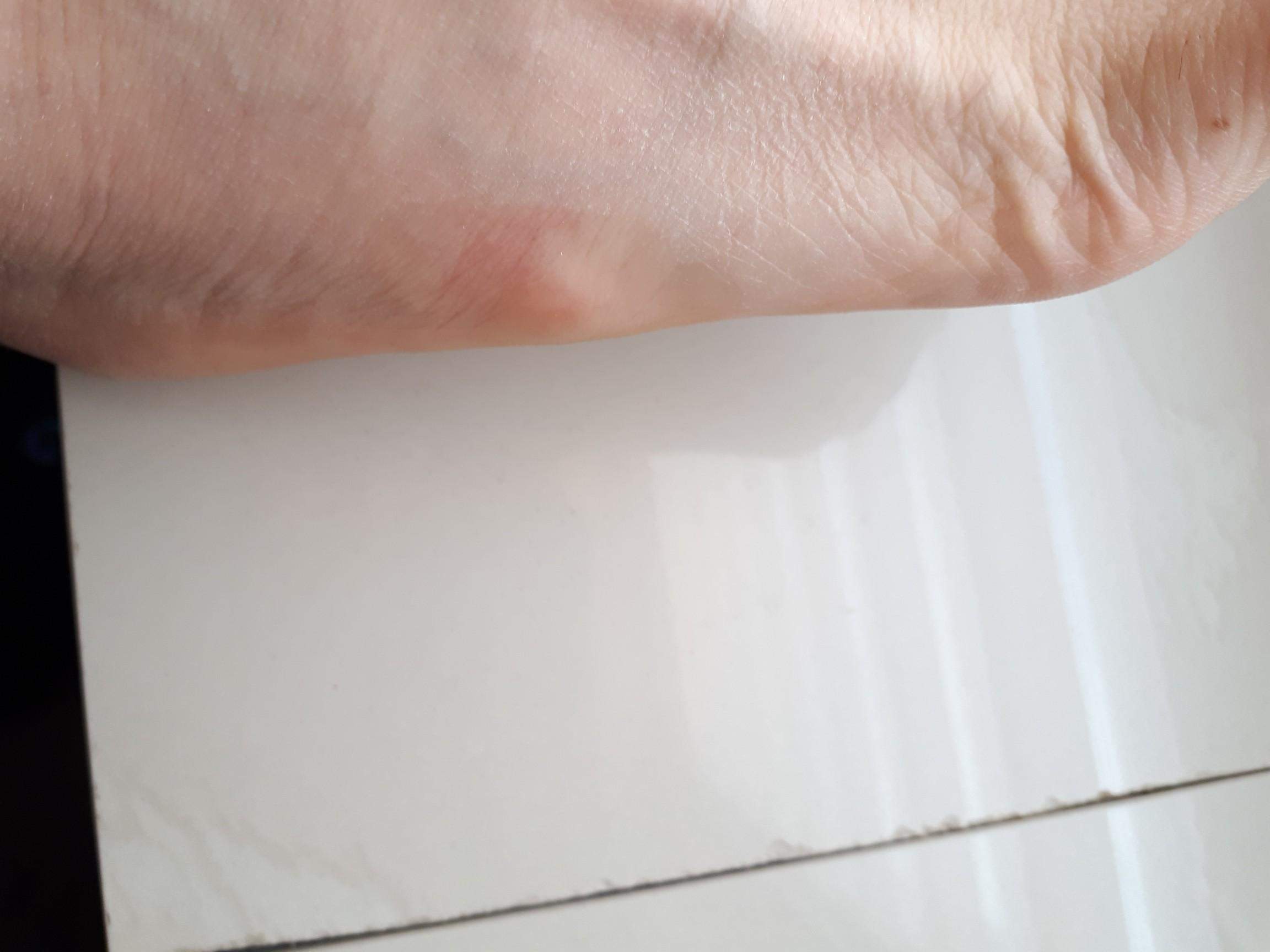 Hubbel seitlich am Fuß. Ganglion? Was machen? (Füße, geschwollen ...