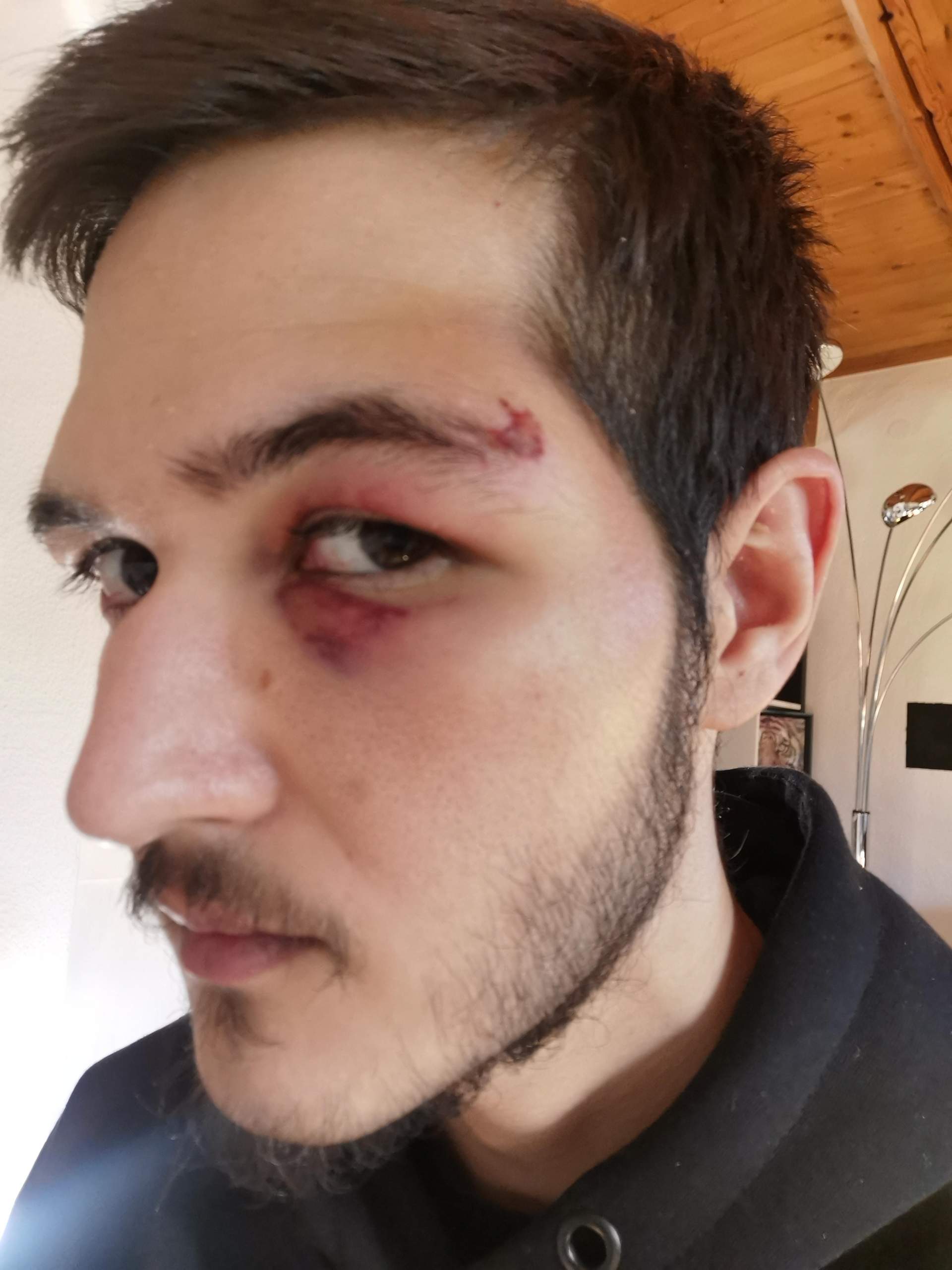 Ist das blaue Auge bis Freitag weg? (Schwellung, Verletzung)