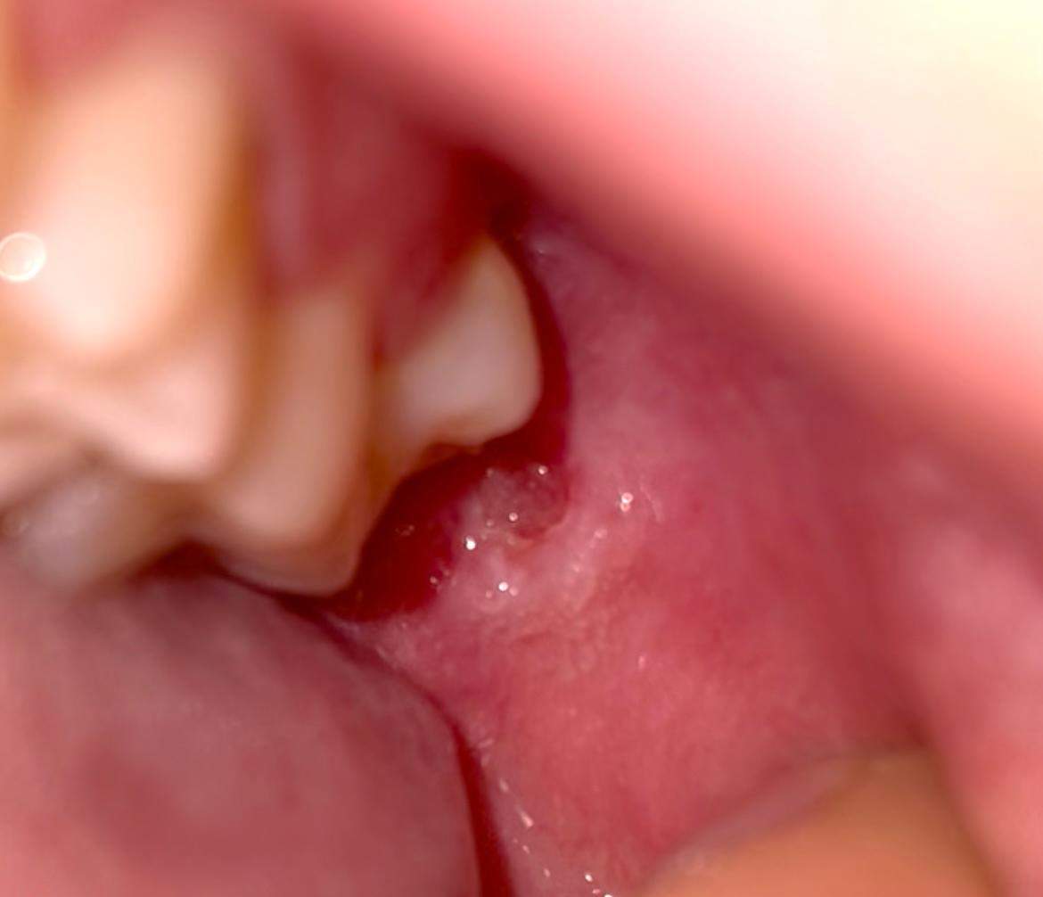 Ist das eine Aphte oder was anderes? (Schmerzen, Entzündung, Schleimhaut)