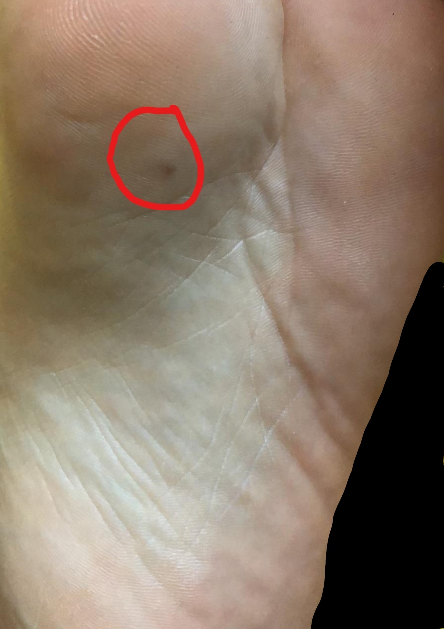 Kleiner Fleck an der Fußsohle neu? (Haut, Füße, Dermatologie)