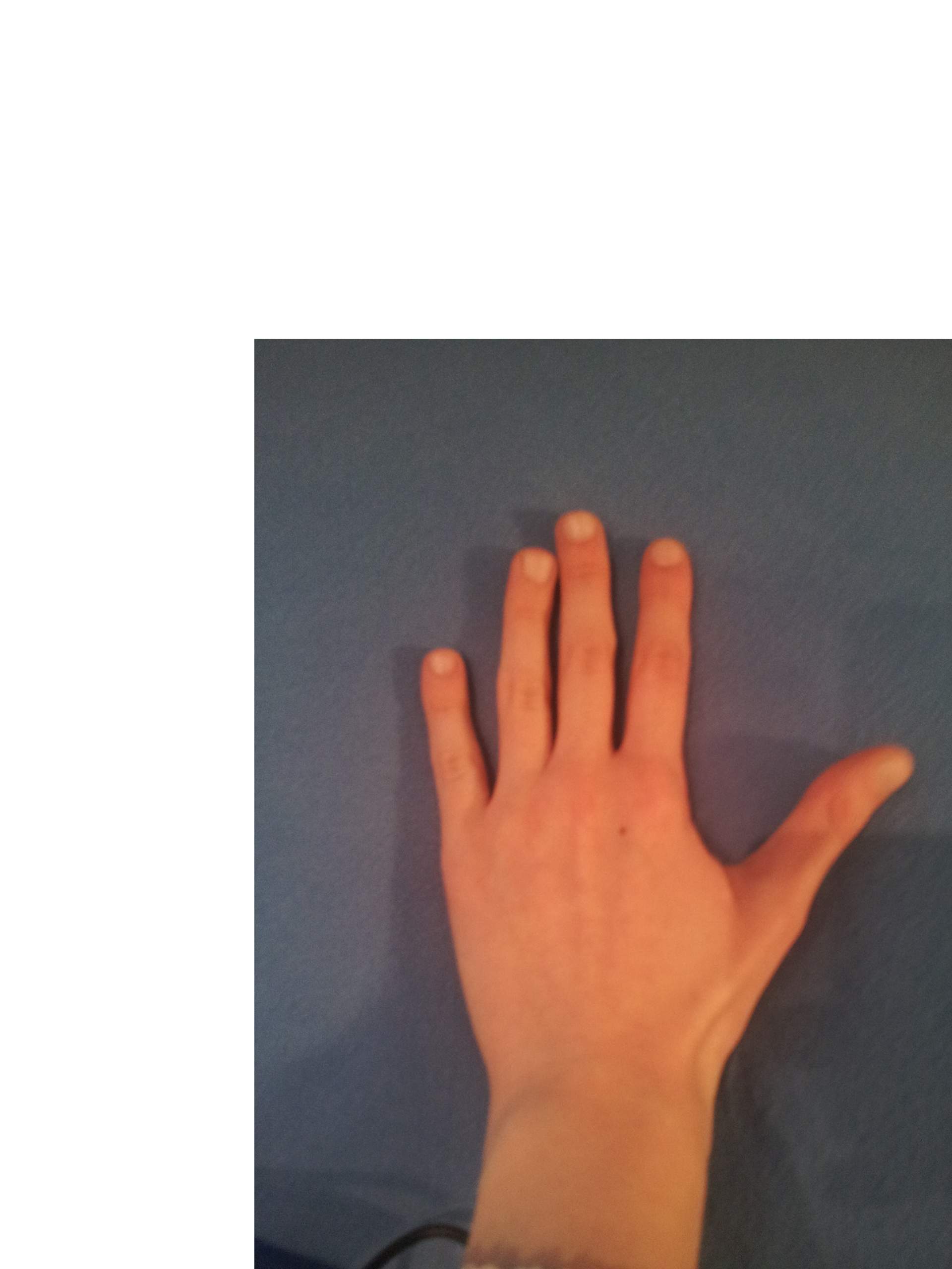 Krumme Finger - Ursache? Was tun? (Orthopädie)