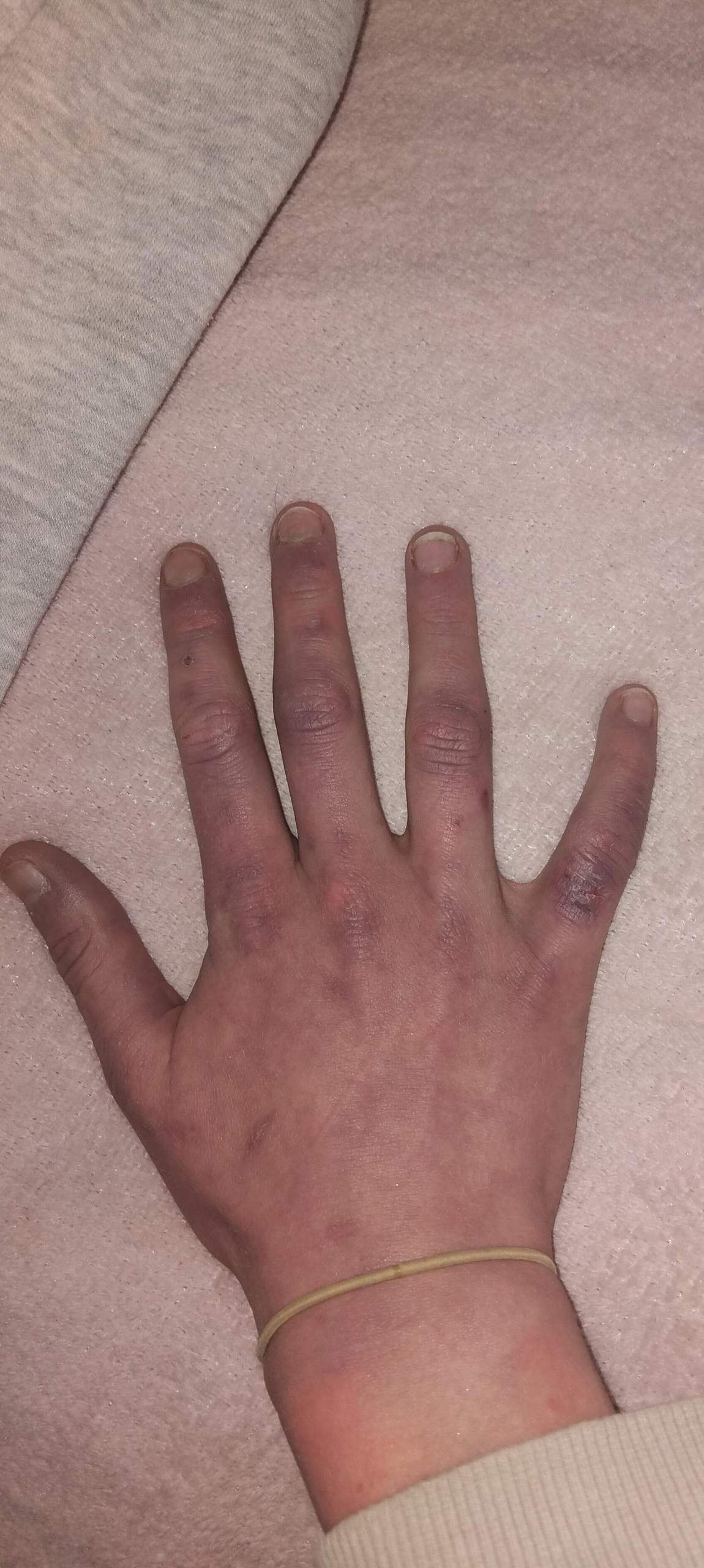 Lila Rote färbung an den händen normal? (Hand)
