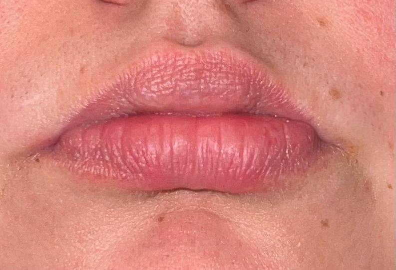 Die Alterung Der Oberlippe , Flecken auf der Lippe: Ursachen, Symptome ...