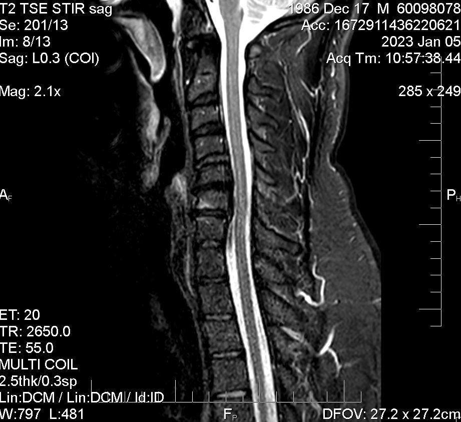Mrt Hws noch kein befund ;(? (Arzt, Operation, Medizin)