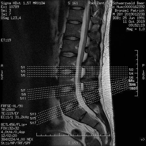 MRT LWS? (Bandscheibe, Lendenwirbelsäule)