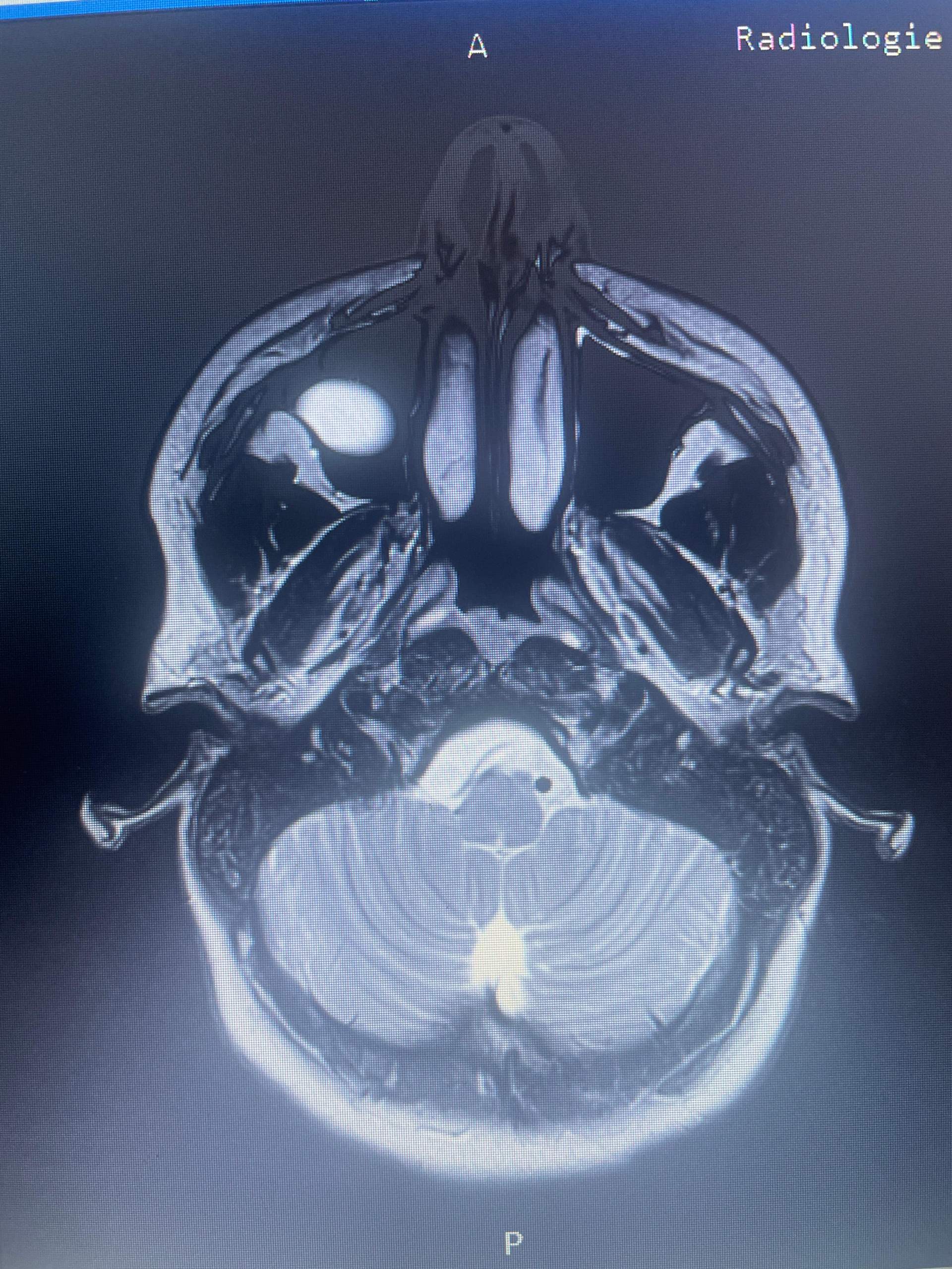 MRT Schädel + KHBW? (HNO)
