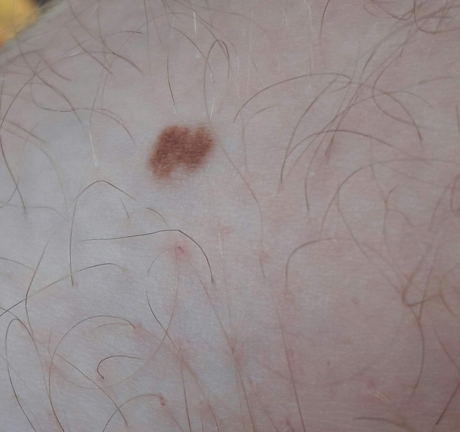 Muttermal verdächtig? (Haut)