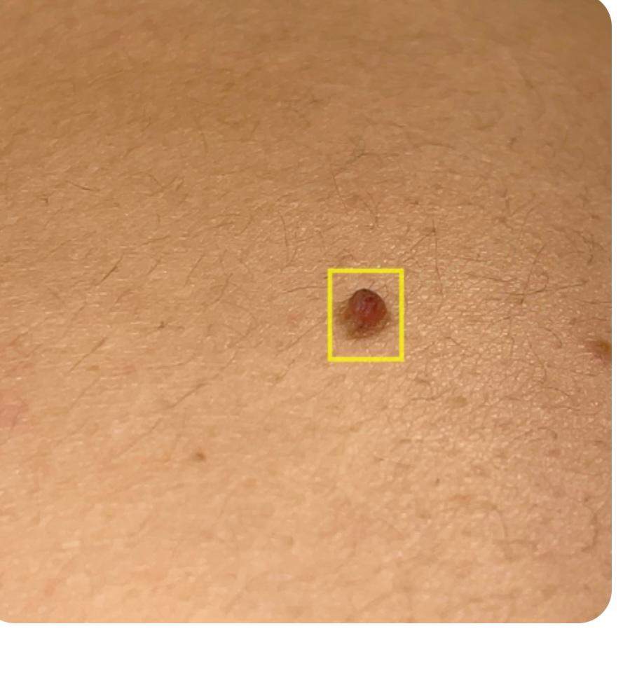 Muttermal wächst in die höhe? (Dermatologie)
