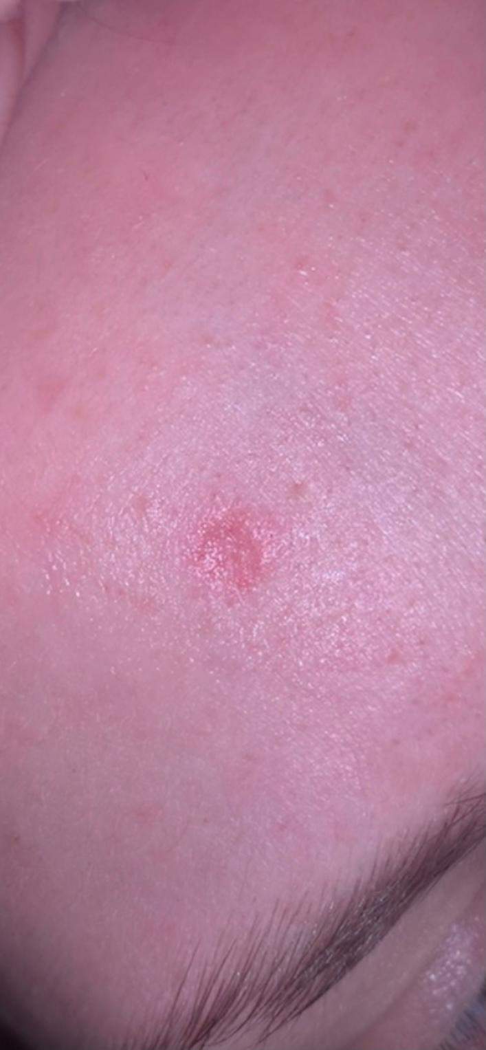 Muttermalentfernung, wächst das noch zu? (Haut, Gesicht, Muttermal)