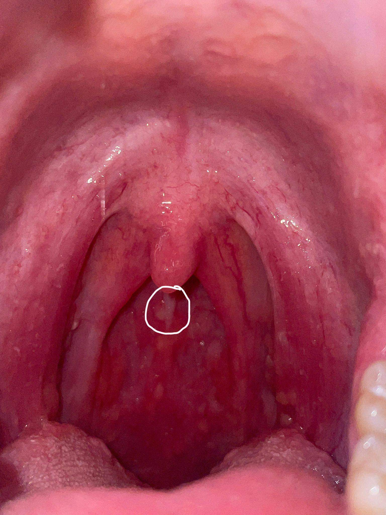 Panische Angst vor Mundkrebs? Angst vor Leukoplakie? (Krebs, Hilfe ... Panische Angst vor Mundkrebs? Angst vor Leukoplakie? (Krebs, Hilfe ...