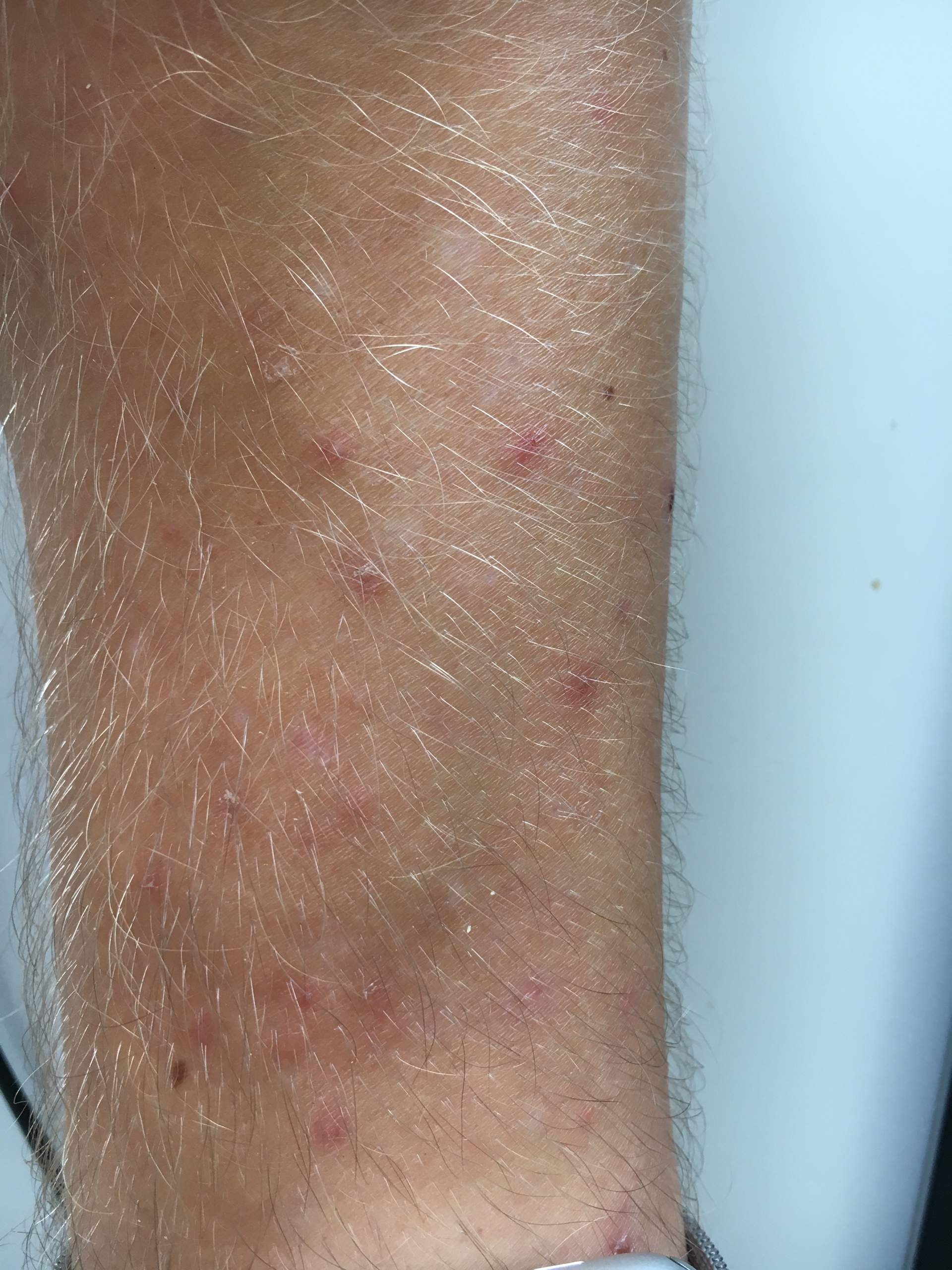 Pickel / Rötungen an den Armen? (Arm, Akne)