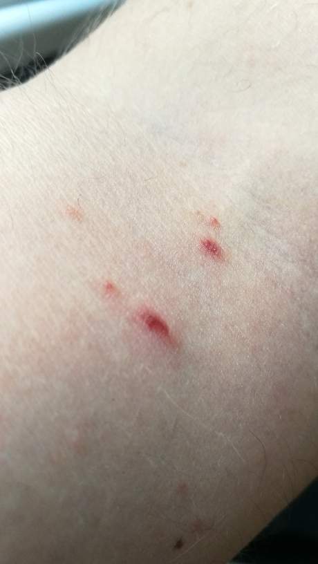 Pickel und Pusteln auf der Haut? Was ist das? Krätze? (Dermatologie)
