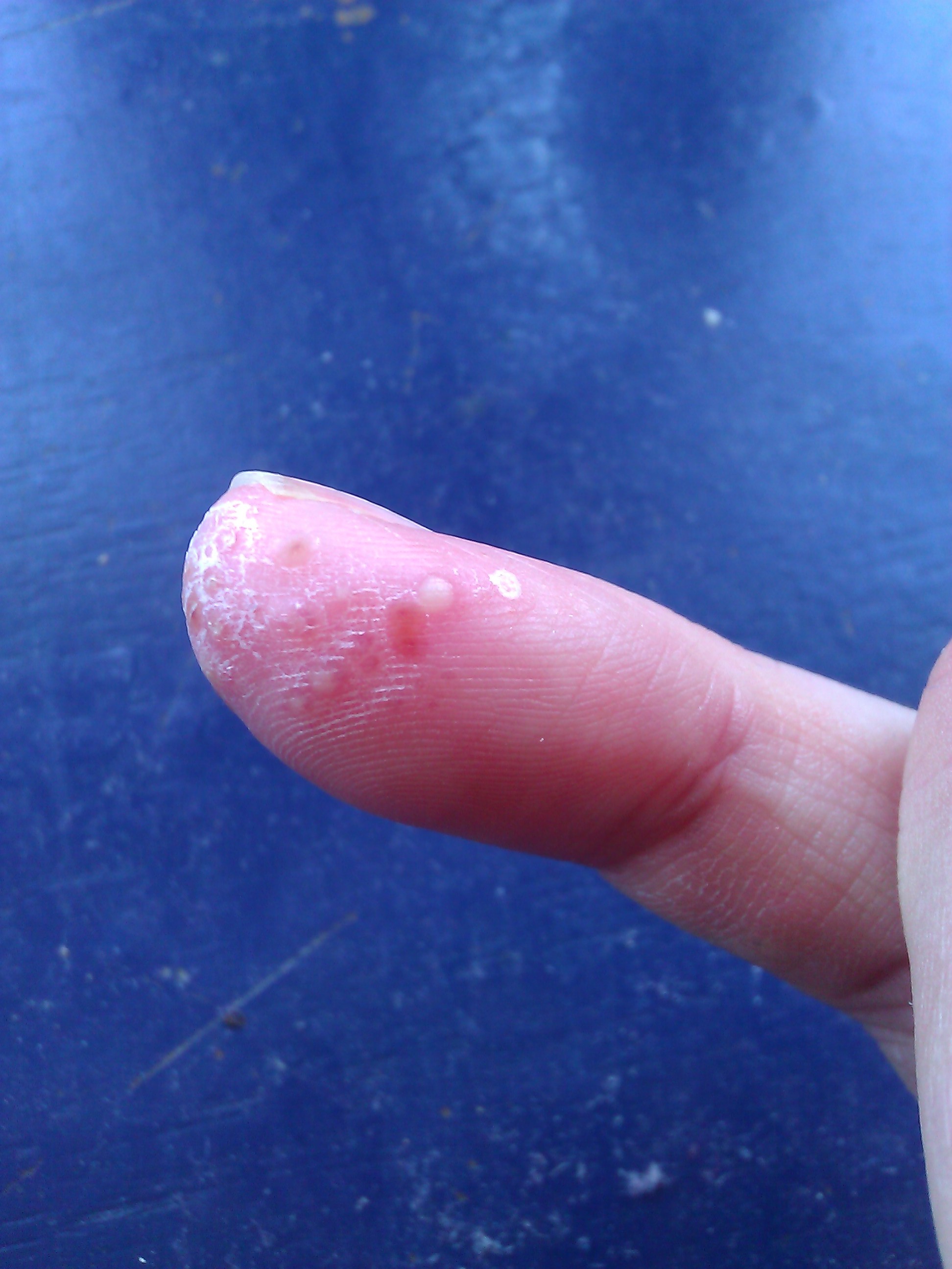 Pilz An Fingerkuppen : Nagelpilz richtig behandeln – FOLR
