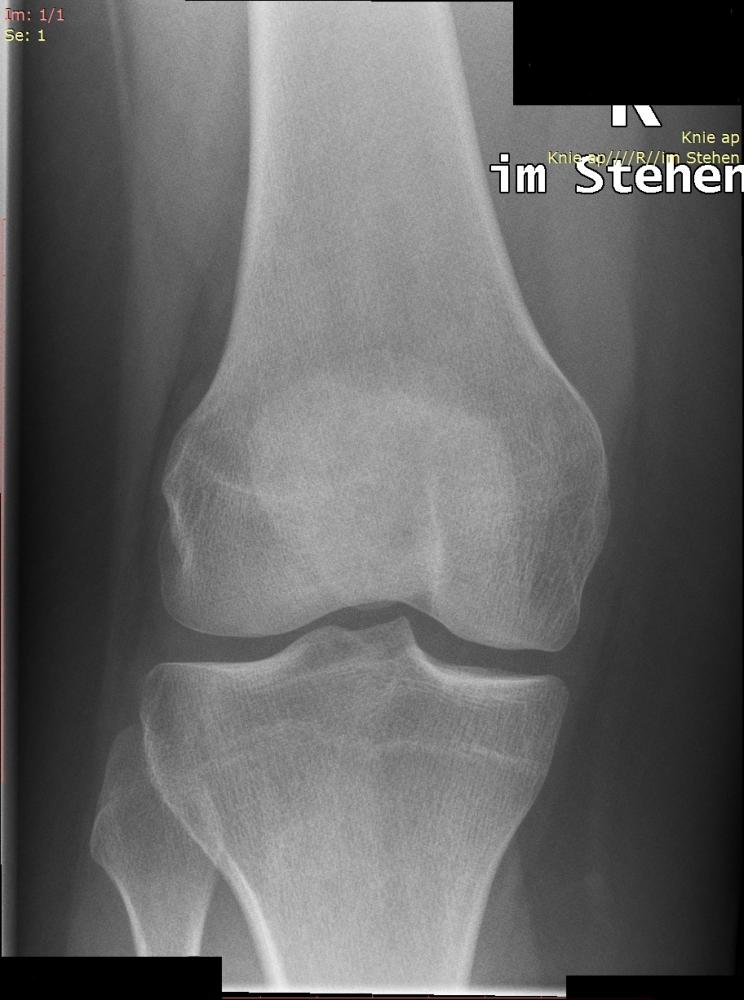 Röntgenbefund Auswertung (Knie, Kniegelenk, Röntgen)