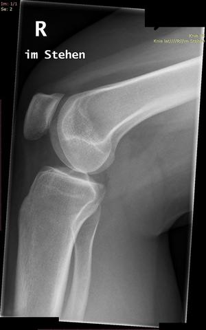 Röntgenbefund Auswertung (Knie, Kniegelenk, Röntgen)