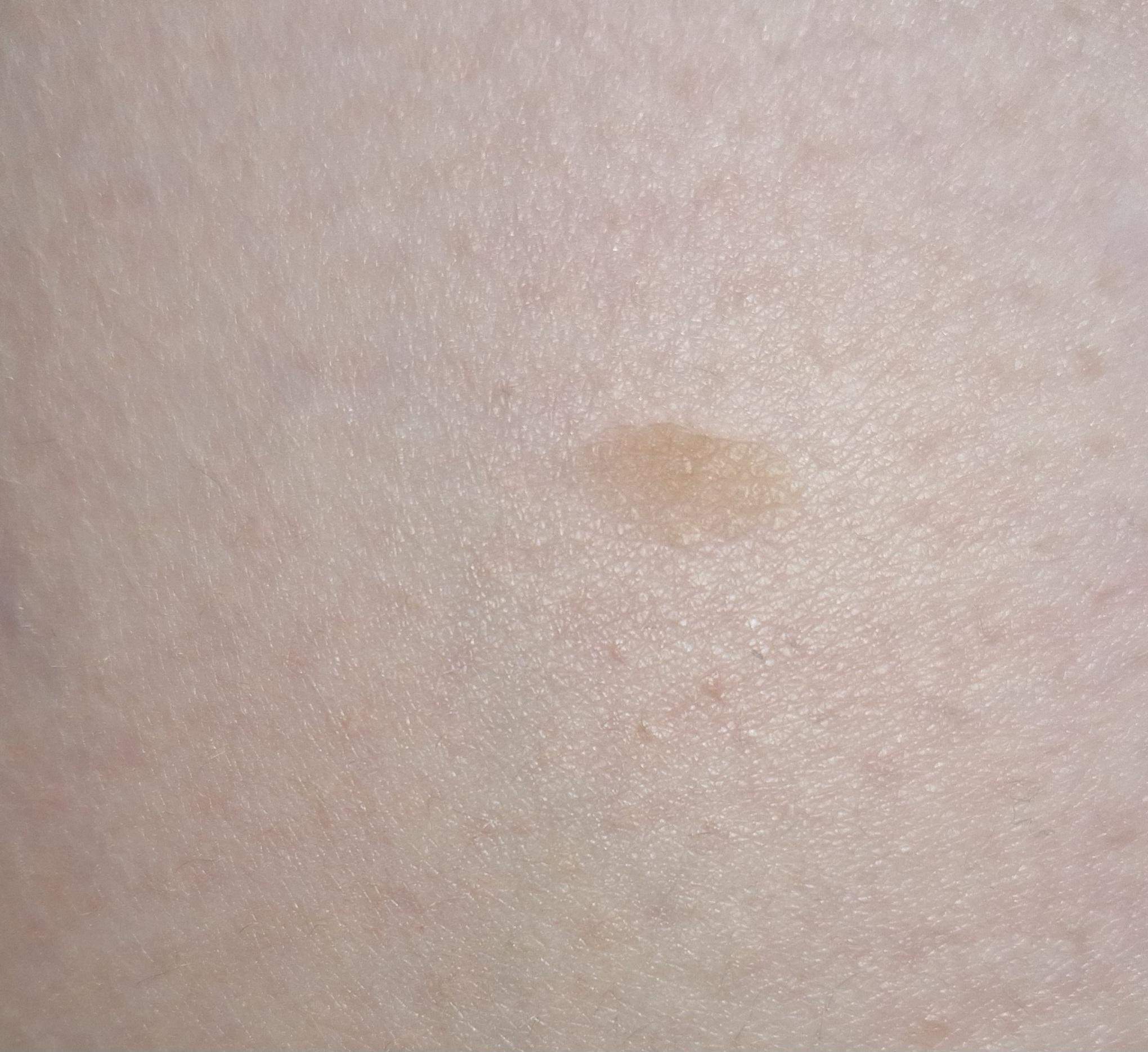 Sieht der Leberfleck komisch aus? (Haut, hautarzt)