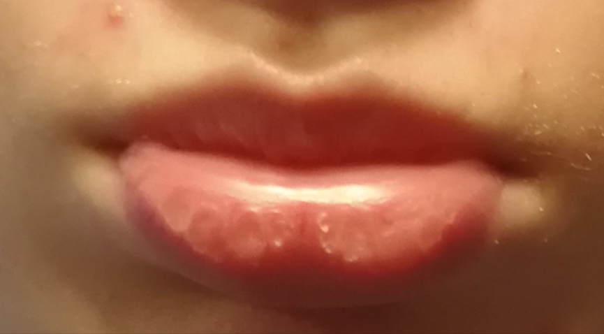 Trockene/harte/schälende Lippen, was tun? (Haut, Gesundheit, Pflege)