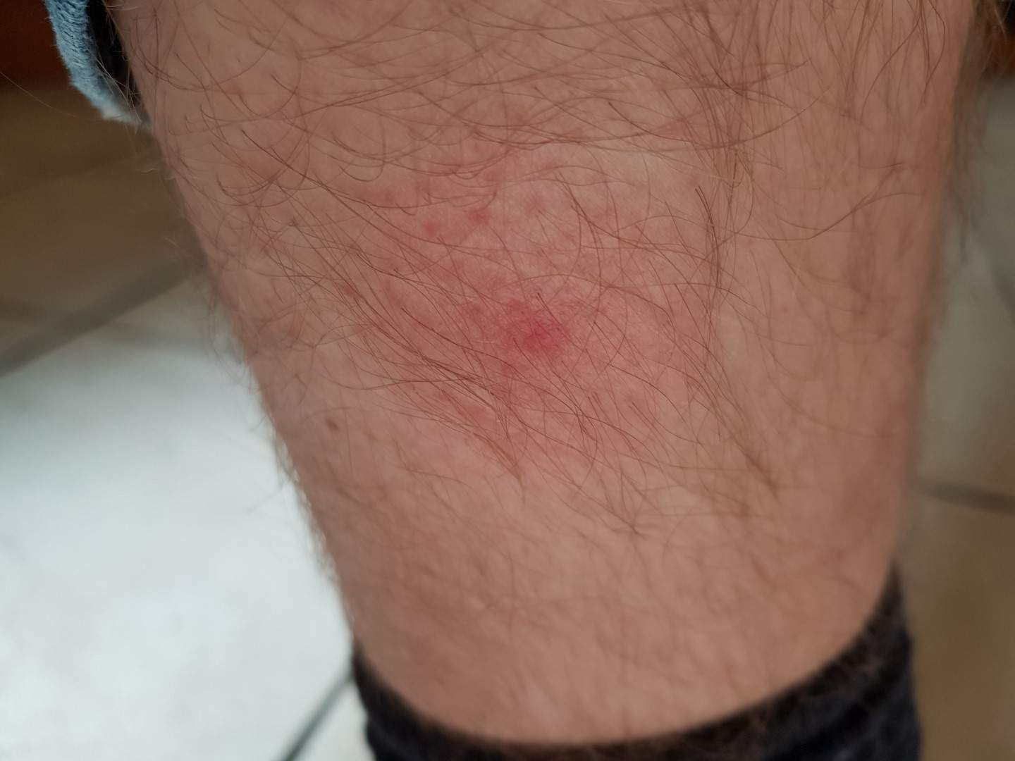 Zecken Stich erst Rötung jetzt Blauer Fleck nach 8 Tagen Borreliose A ...